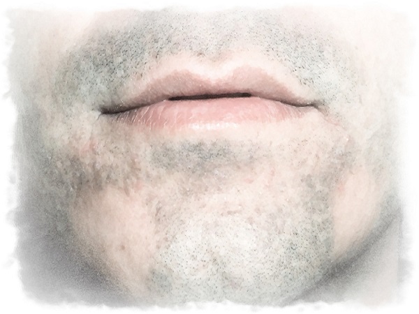 ತೇಪೆ ರೀತಿಯಲ್ಲಿ ಗಡ್ಡ ಬೋಳು ಆಗುತ್ತಿದ್ಯಾ? ಇದಕ್ಕೆ ಕಾರಣವೇನು? ಪರಿಹಾರವೇನು ...